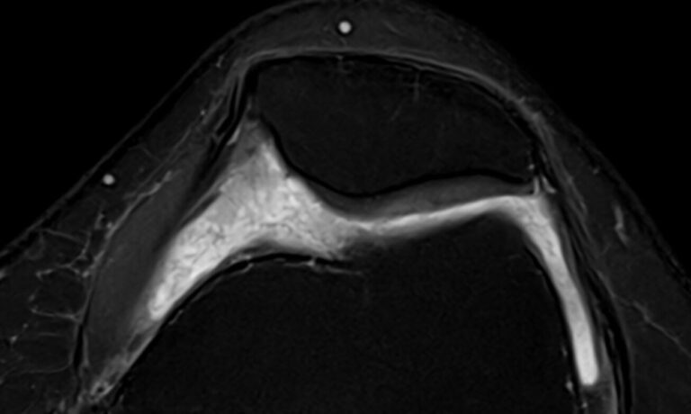 Arthrofibrose im MRI – Diagnostik und Bildmerkmale - radiologie24